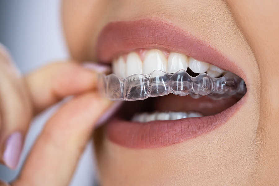 What Happens in First Week of Invisalign? | Invisalign NW Calgary