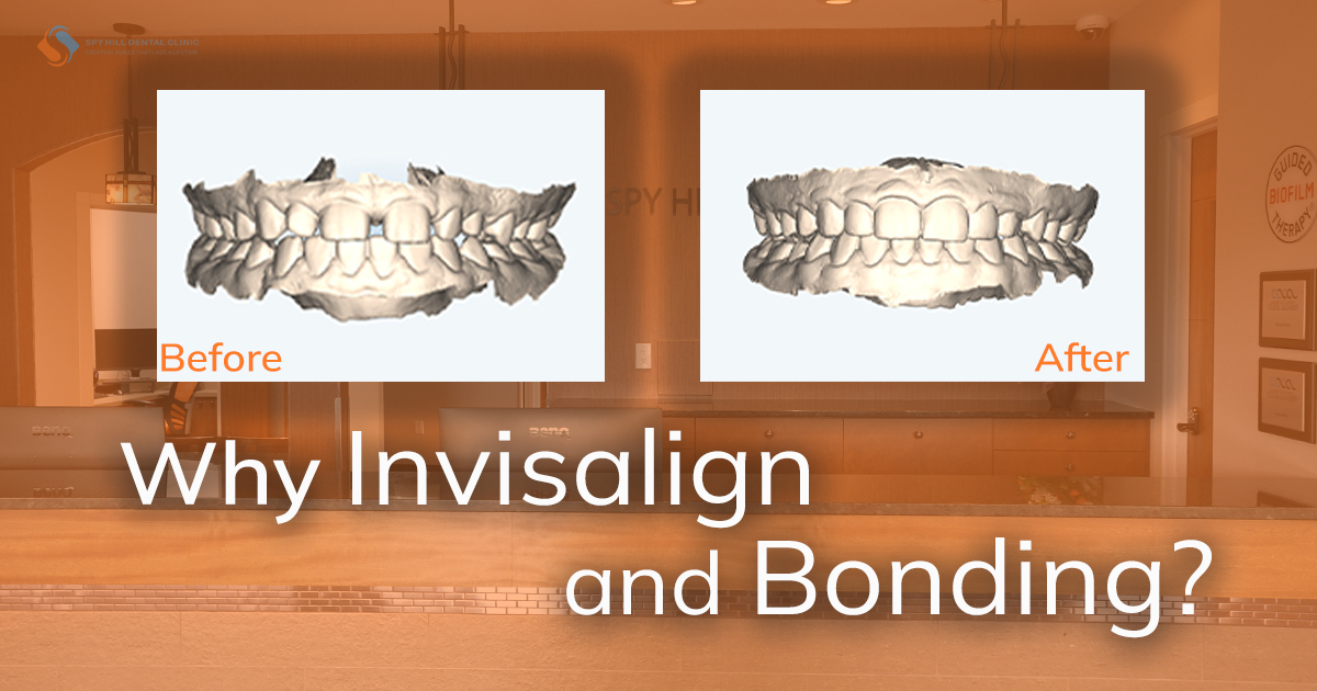 Smile Makeover: Invisalign® and Bonding | Spy Hill Dental