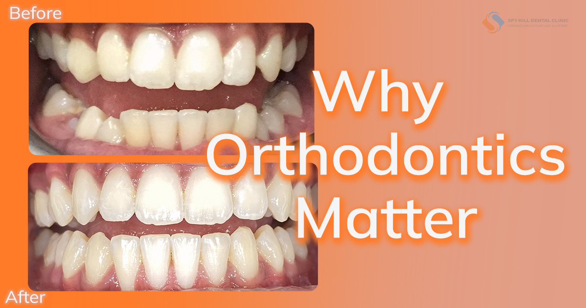The Benefits Of Invisalign® For Healthier, Straighter Teeth - Spy Hill ...